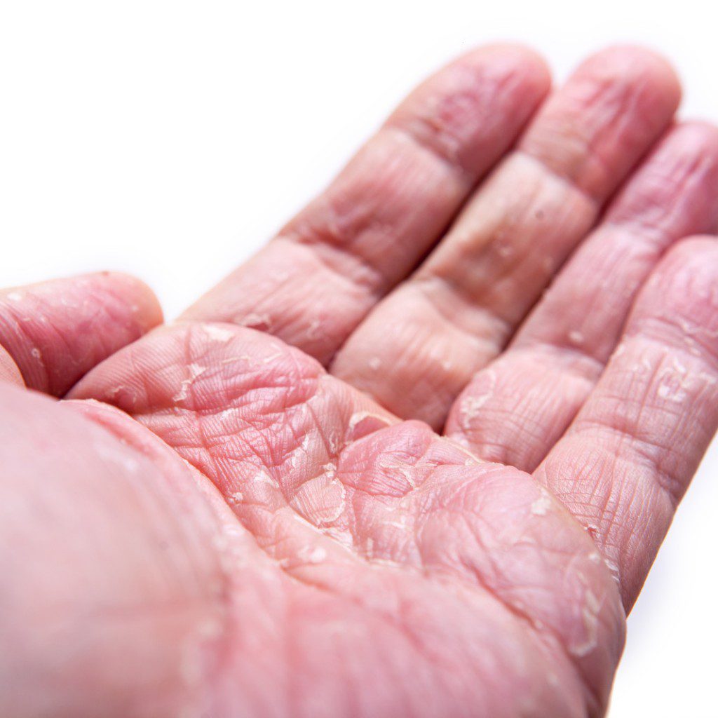 Fix Skin Problems Psoriasis, Eczema, and Hidradenitis